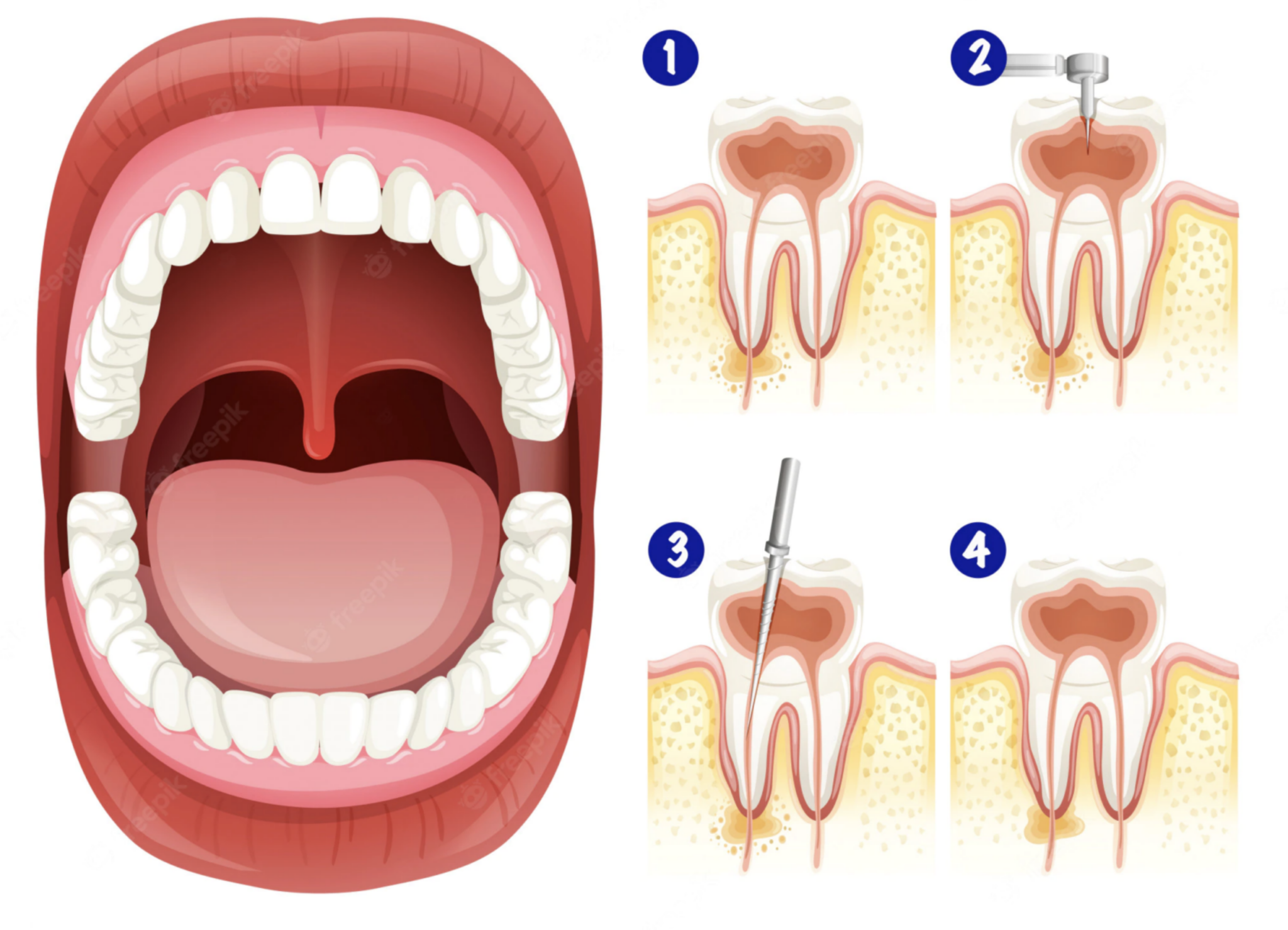 A Guide to Root Canals - Dental Country™